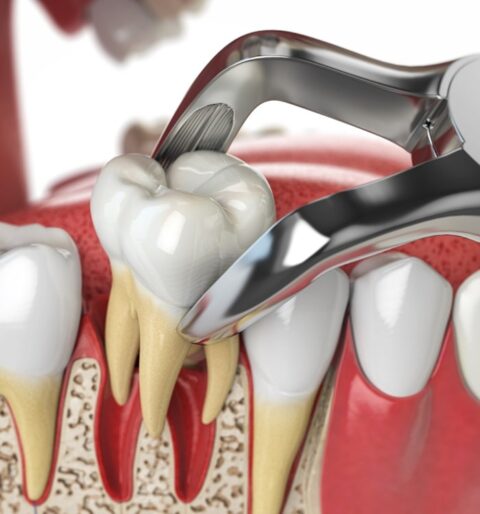 Teeth Extractions - Mercato Dental Centre